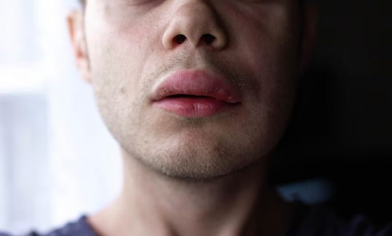 A Comprehensive Guide To Angioedema Treatment
